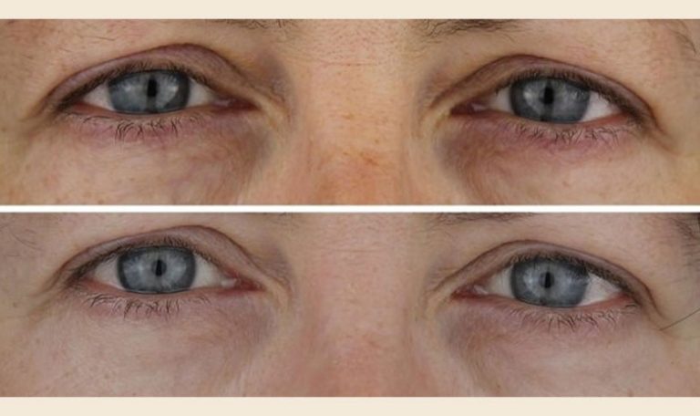 Meso under eye treatment - Pro Age Clinic - UAE