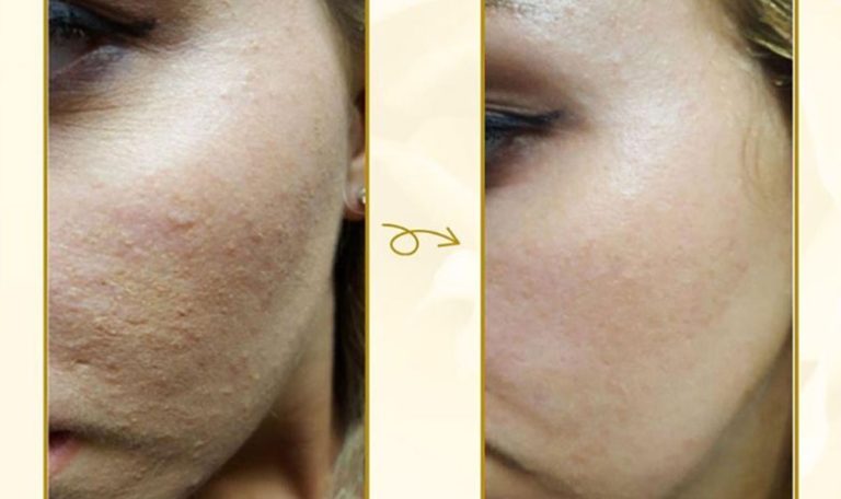 Subcision - Pro Age Clinic - UAE
