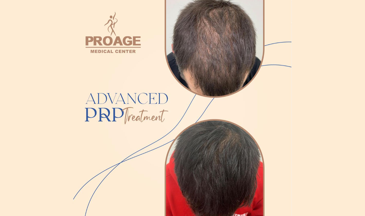 Advanced PRP – Pro Age Clinic – UAE