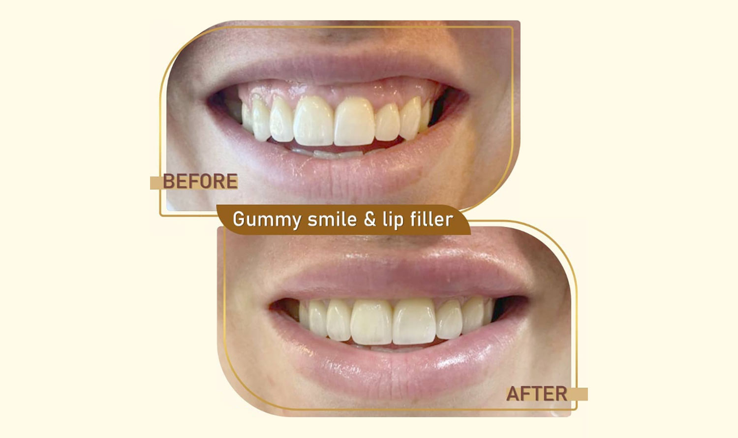 Gummy Smile and Lip Filler - Pro Age Clinic - UAE